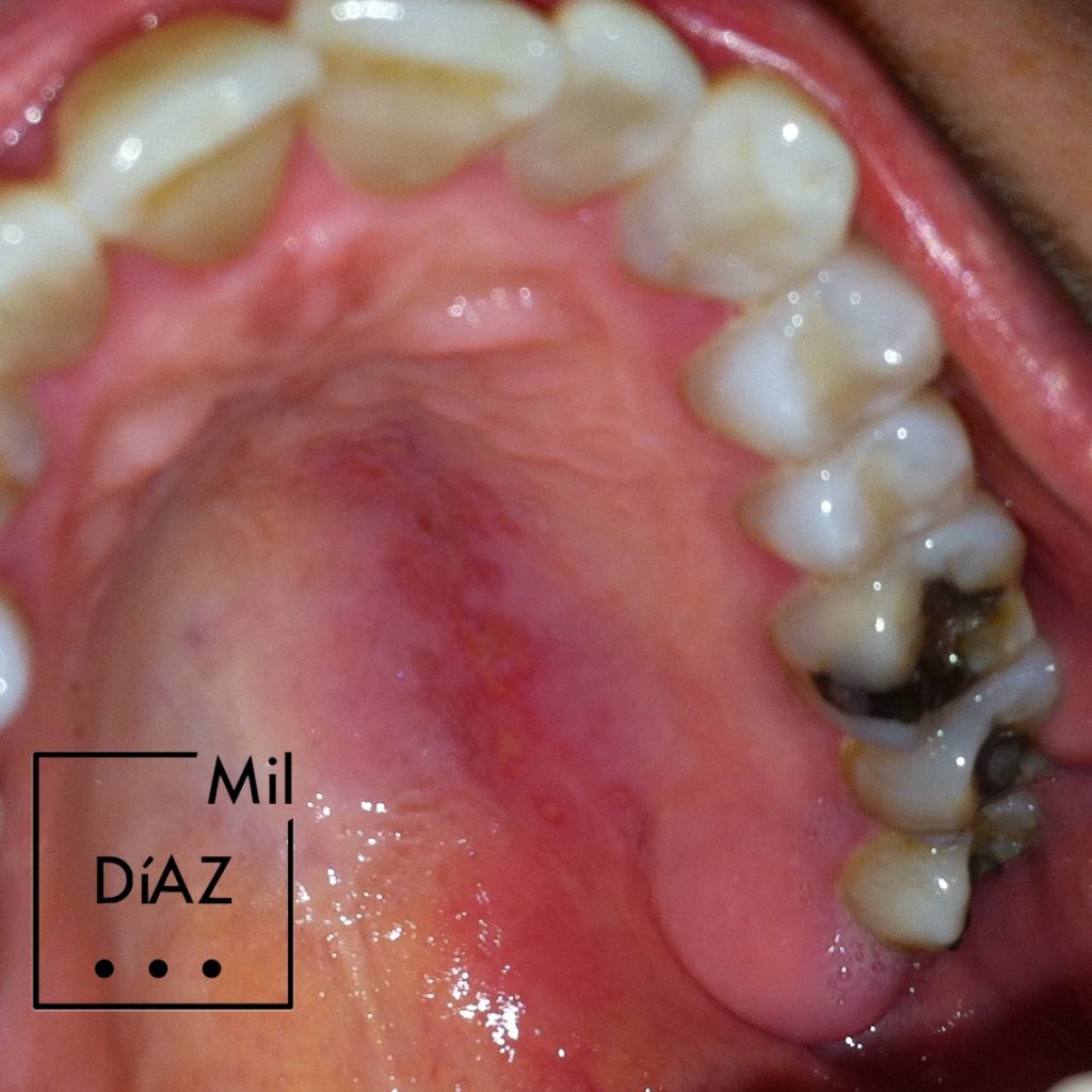 Intraoral Herpes Mouth Ulcers, Cold Sores, And Other Mouth Irritations